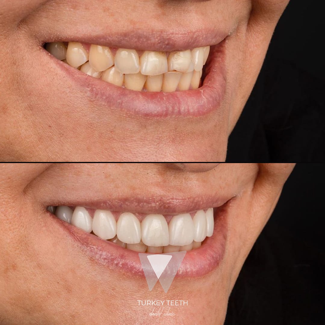 Smile Makeover Turkey – Transform Your Smile in Antalya