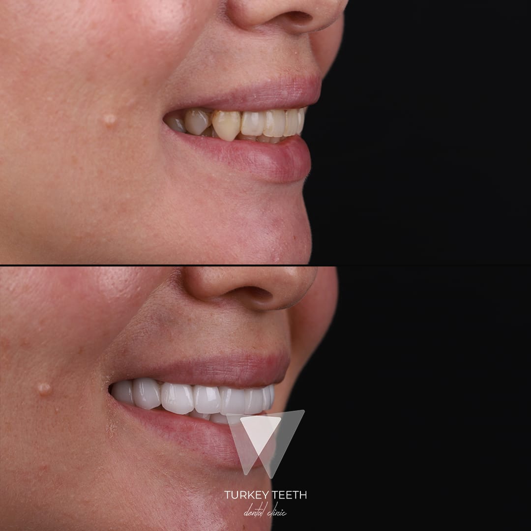 Smile Makeover Turkey – Transform Your Smile in Antalya