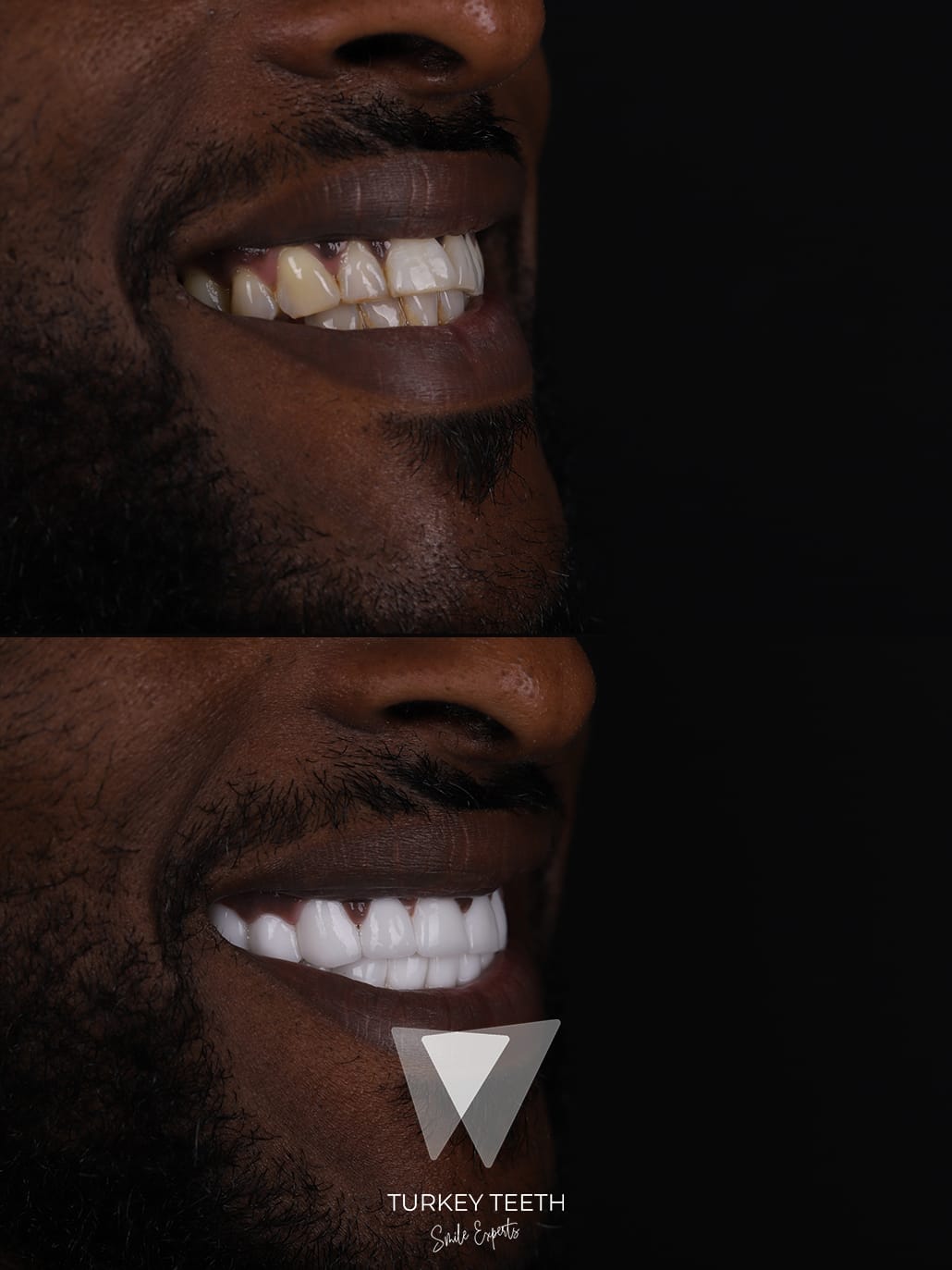 Teeth Whitening Turkey - Professional Smile Brightening in Antalya