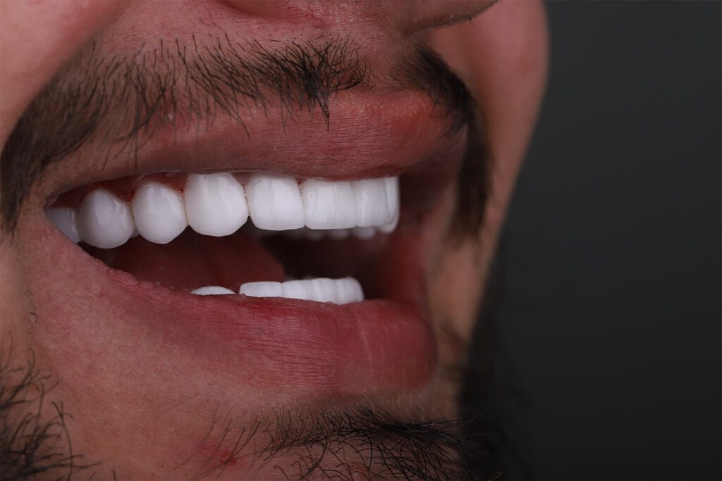 Hollywood Smile Before and After – Stunning Side View Result