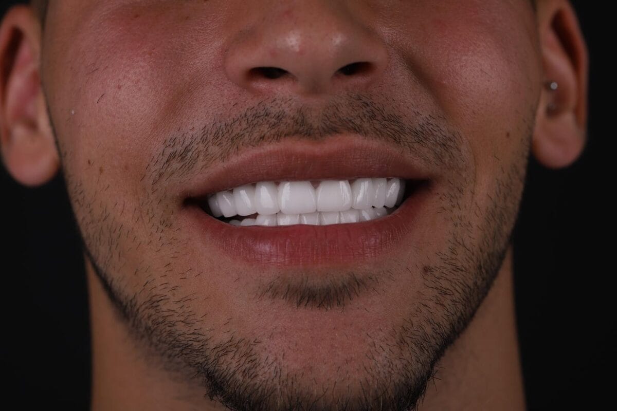 Chipped Teeth Smile Makeover Turkey – Full Restoration Case